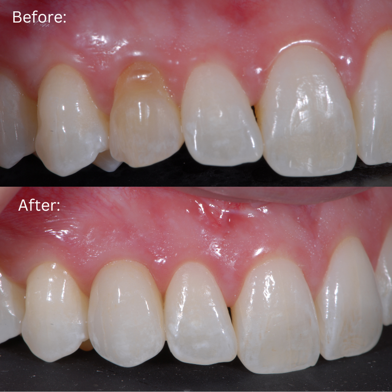 Tooth Replacement Options - Eric Hull Aesthetic & General Dentistry ...