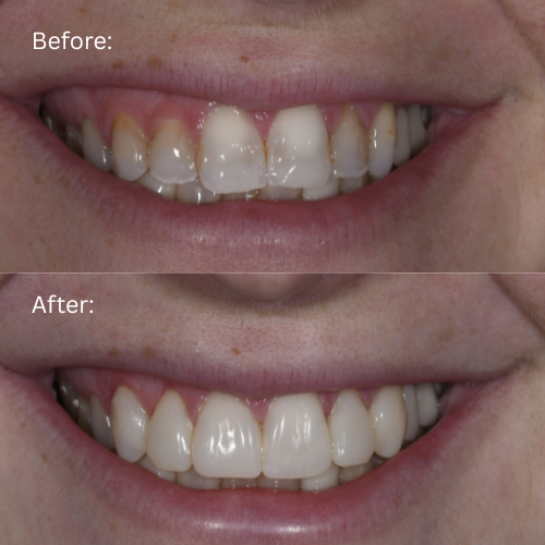 Injection Molded Composite Veneers in Grand Rapids - Eric Hull DDS
