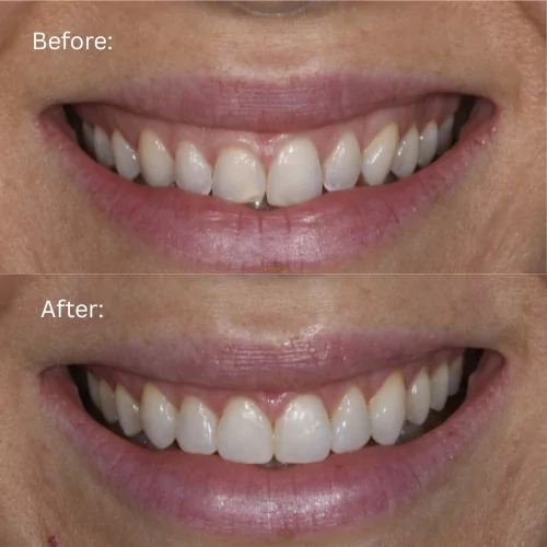 Injection Molded Composite Veneers in Grand Rapids - Eric Hull DDS