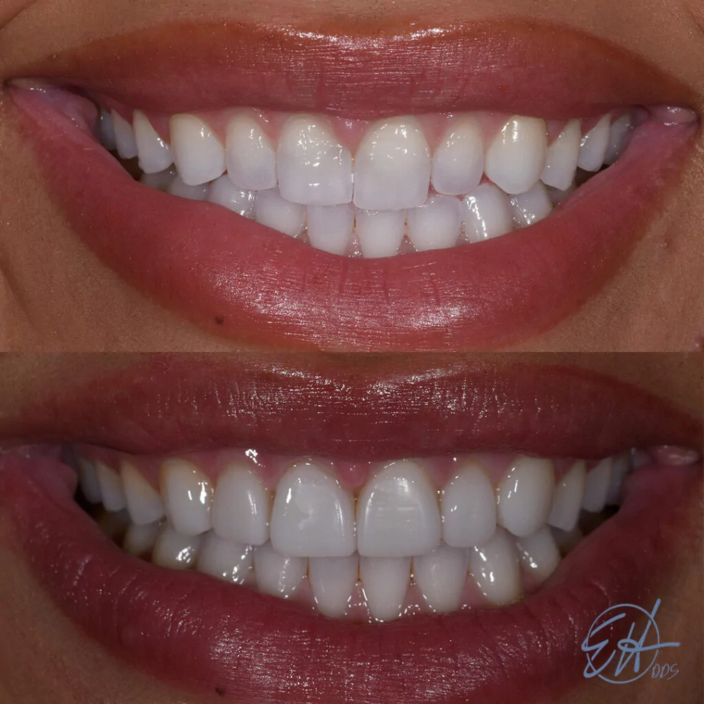 Injection Molded Composite Veneers in Grand Rapids - Eric Hull DDS