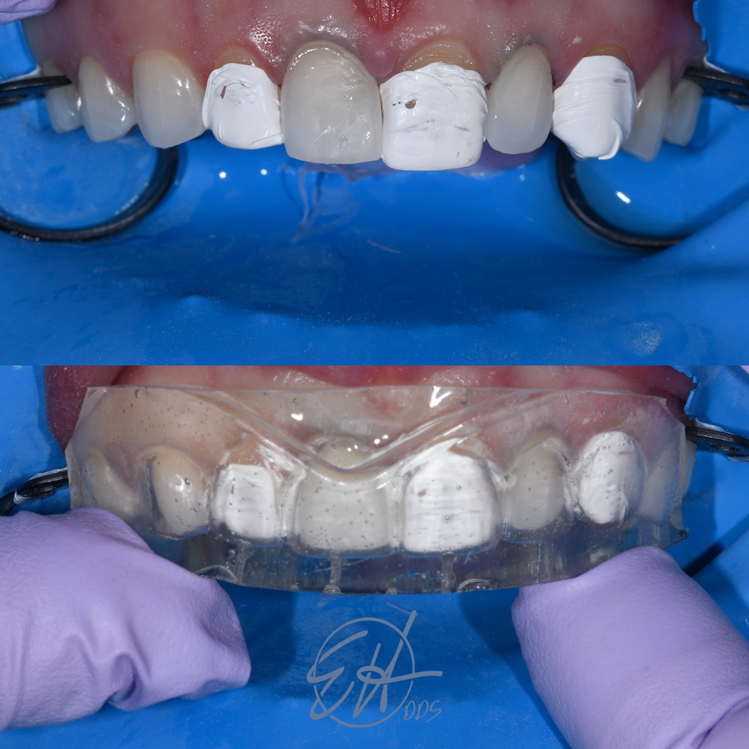 Injection Molded Composite Veneers in Grand Rapids - Eric Hull DDS
