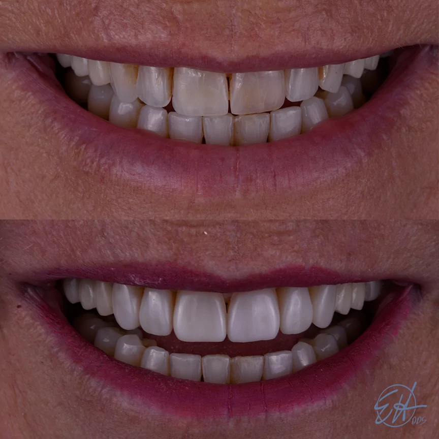 Injection Molded Composite Veneers in Grand Rapids - Eric Hull DDS